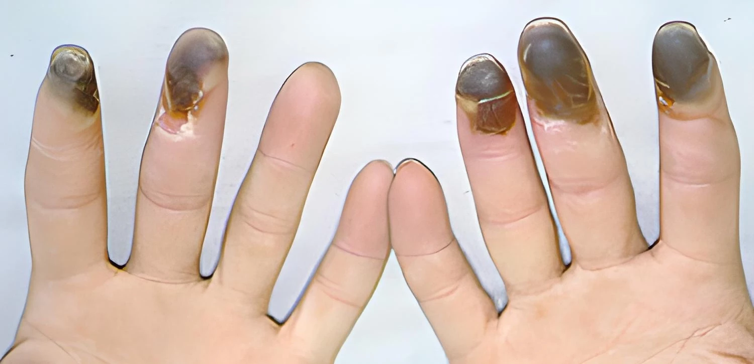 BỆNH BUERGER: NGUY CƠ CẮT CỤT CHI VÌ HÚT THUỐC LÁ