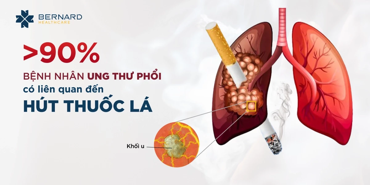 HƠN 90% BỆNH NHÂN UNG THƯ PHỔI CÓ LIÊN QUAN ĐẾN HÚT THUỐC LÁ