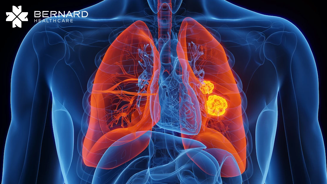 TẠI SAO NÊN TẦM SOÁT UNG THƯ PHỔI DÙ ĐÃ NGỪNG HÚT THUỐC LÂU NĂM?