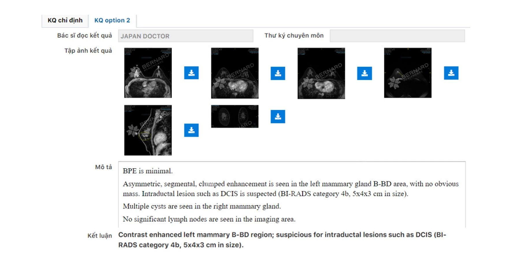 KỊP THỜI PHÁT HIỆN UNG THƯ VÚ GIAI ĐOẠN RẤT SỚM KHI TẦM SOÁT CHUYÊN SÂU ...