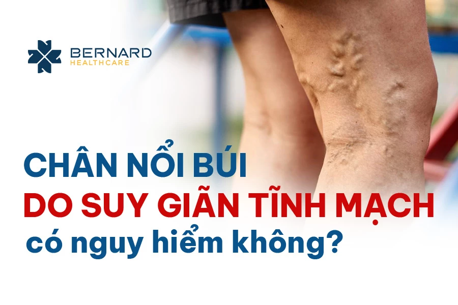 CHÂN NỔI BÚI DO SUY GIÃN TĨNH MẠCH CÓ NGUY HIỂM KHÔNG?