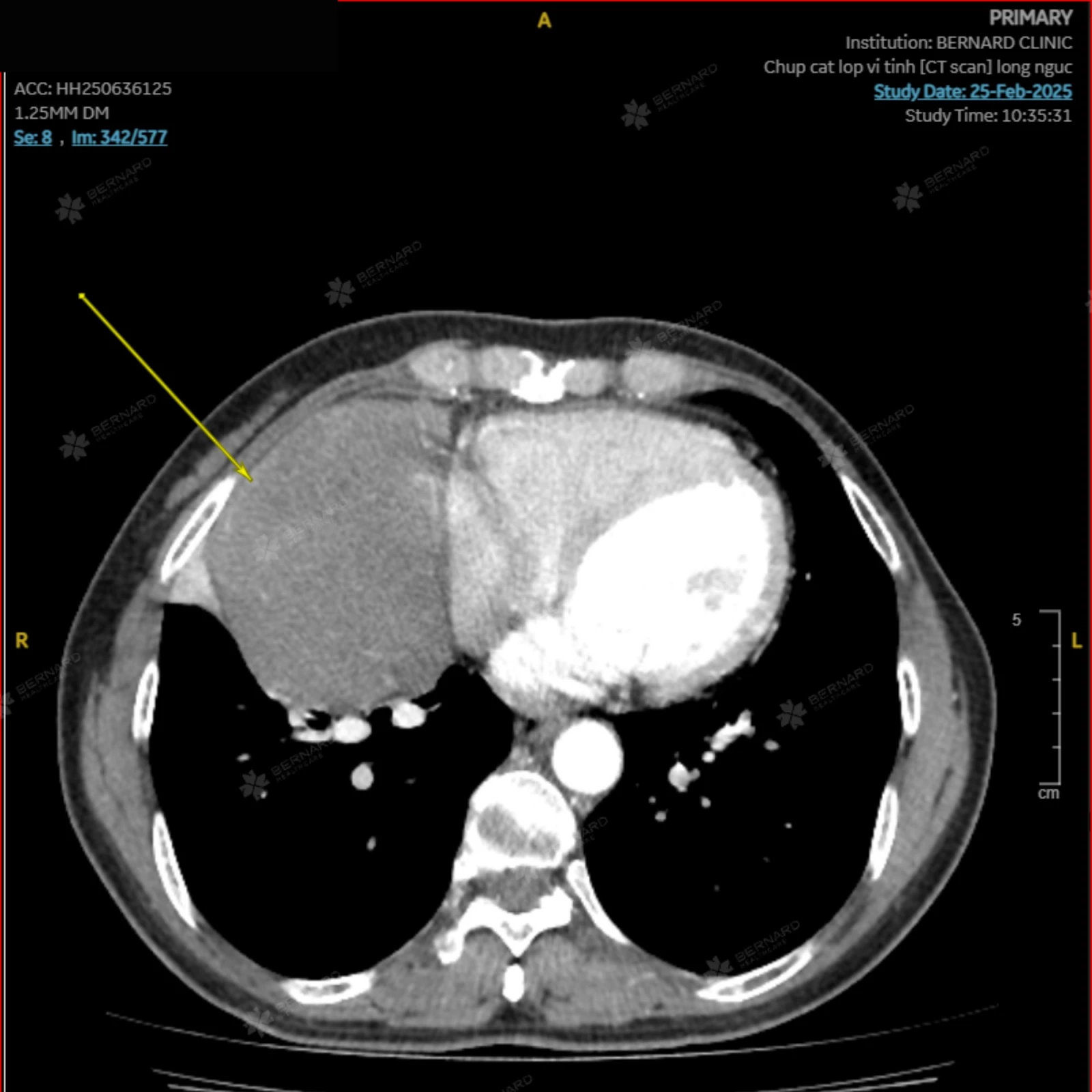 PHÁT HIỆN SỚM KHỐI U TRUNG THẤT KÍCH THƯỚC LỚN, GIÚP HẠN CHẾ XẸP PHỔI ...