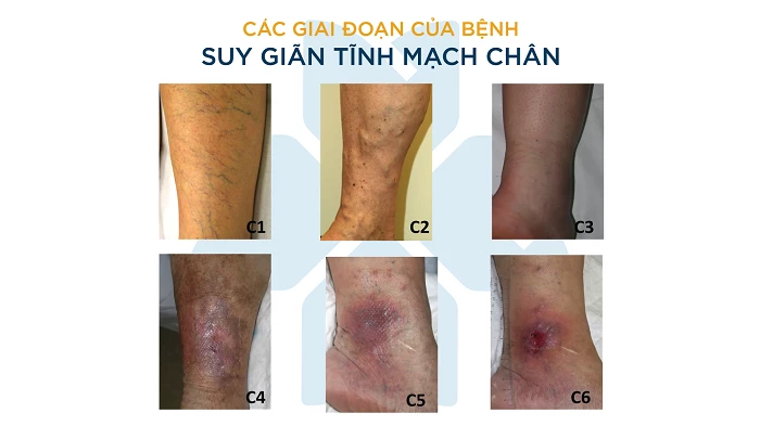 SUY GIÃN TĨNH MẠCH CHI DƯỚI - CẦN HIỂU ĐÚNG VÀ ĐỦ